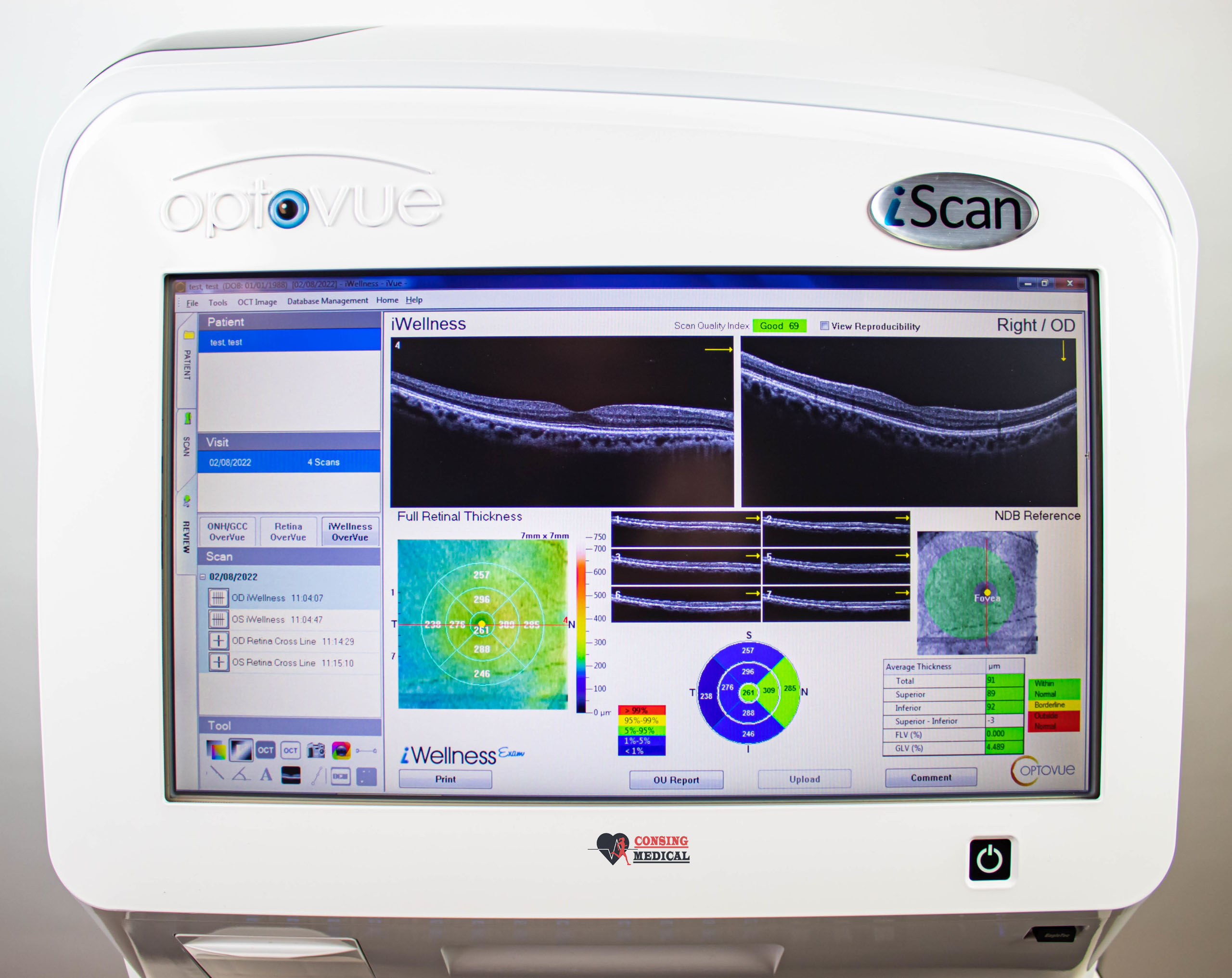 New Optovue IScan OCT - Consing Medical